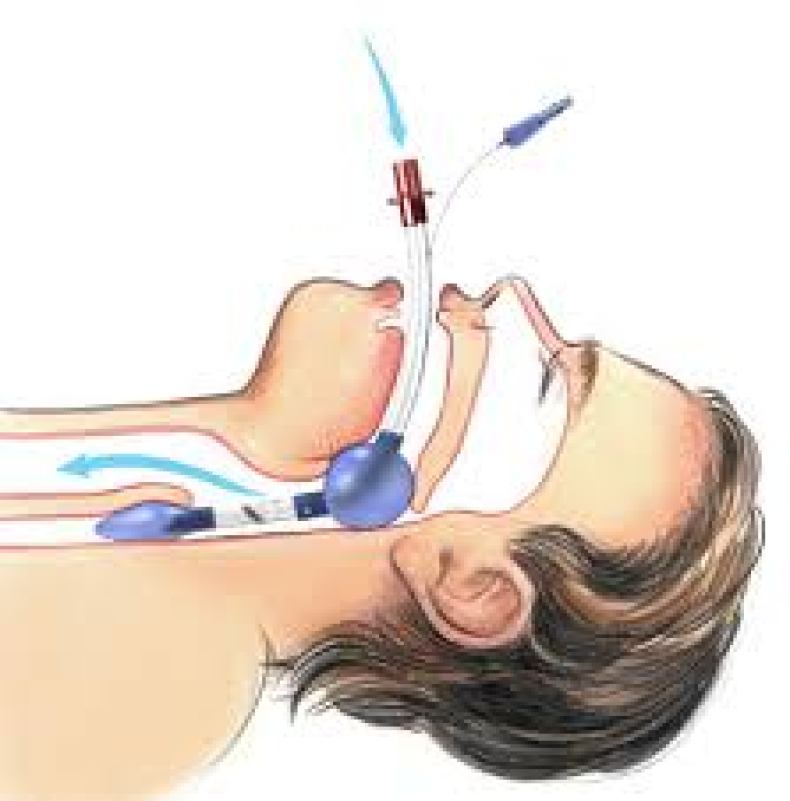 Intubación Endotraqueal Mantenimiento